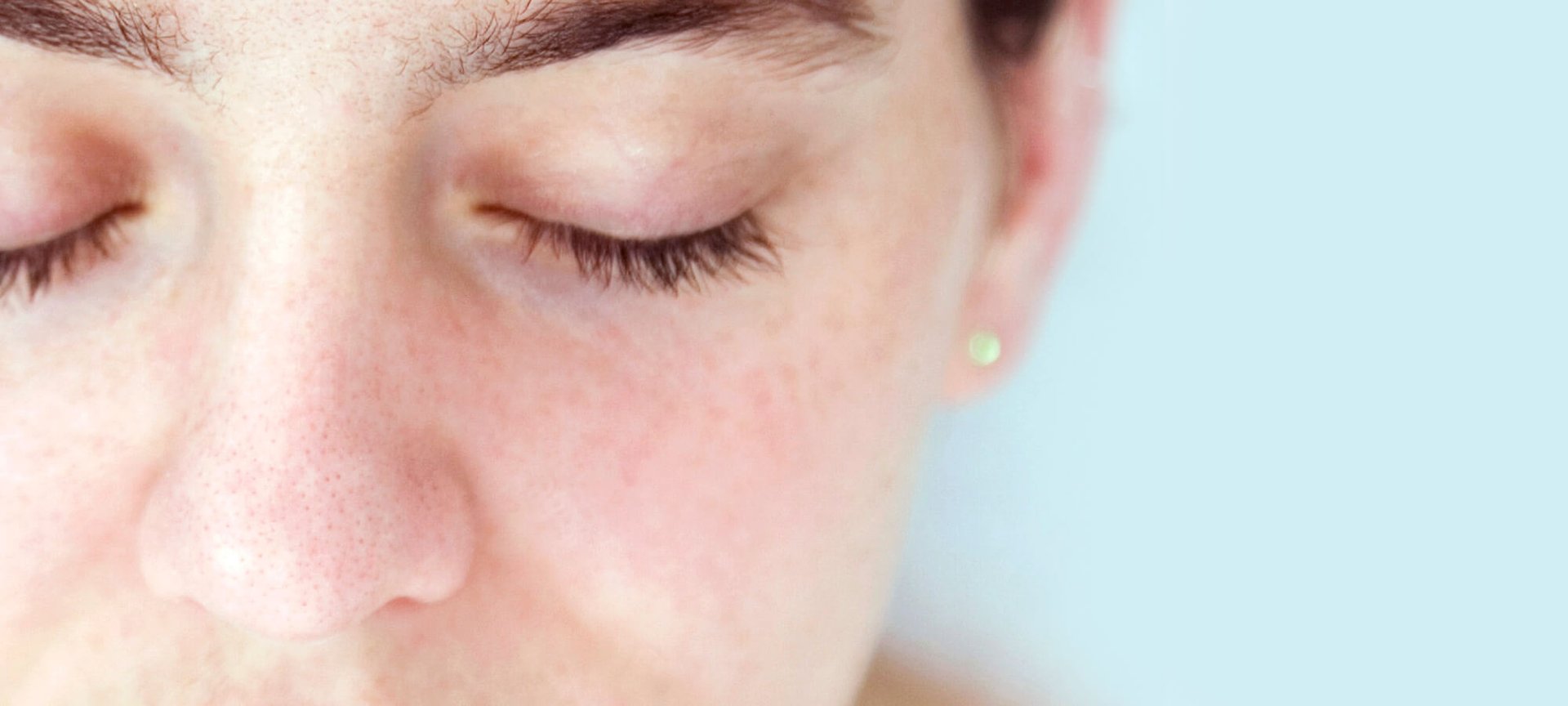 Komedo Hitam di Hidung? Ini Cara Ampuh Menghilangkannya